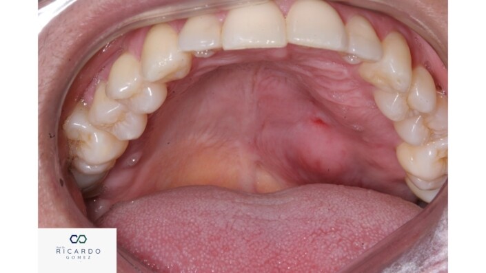 Carcinoma Adenoide Cístico - Patologia Bucal
