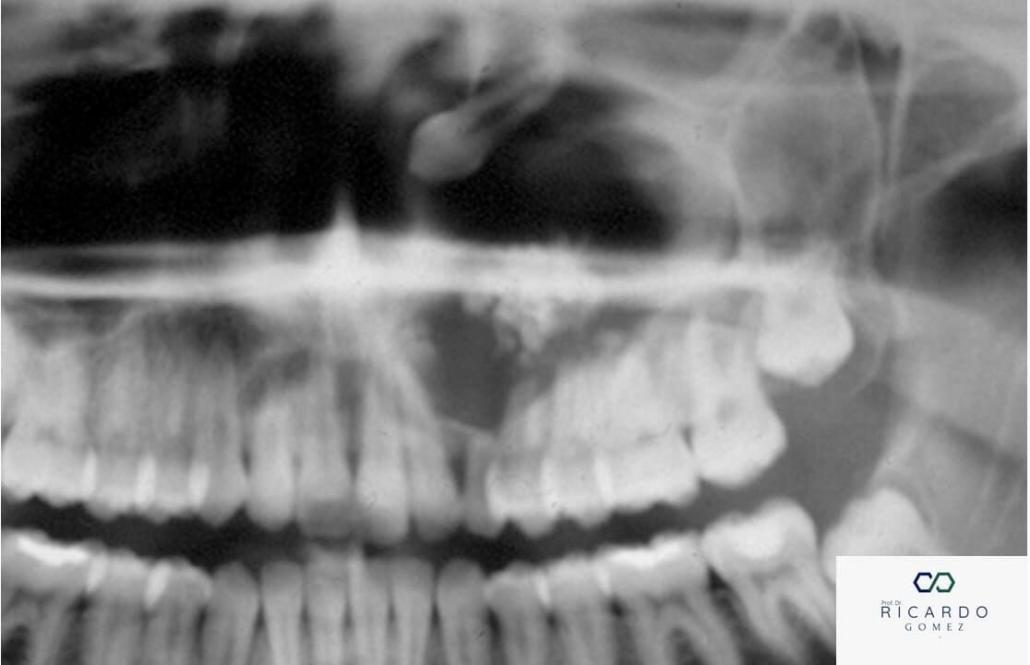 Cisto Odontogênico Calcificante - Patologia Bucal