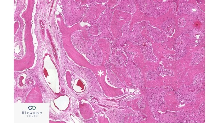 Displasia Fibrosa - Patologia Bucal