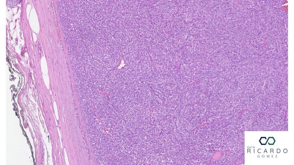 Adenoma de células basais - Patologia Bucal