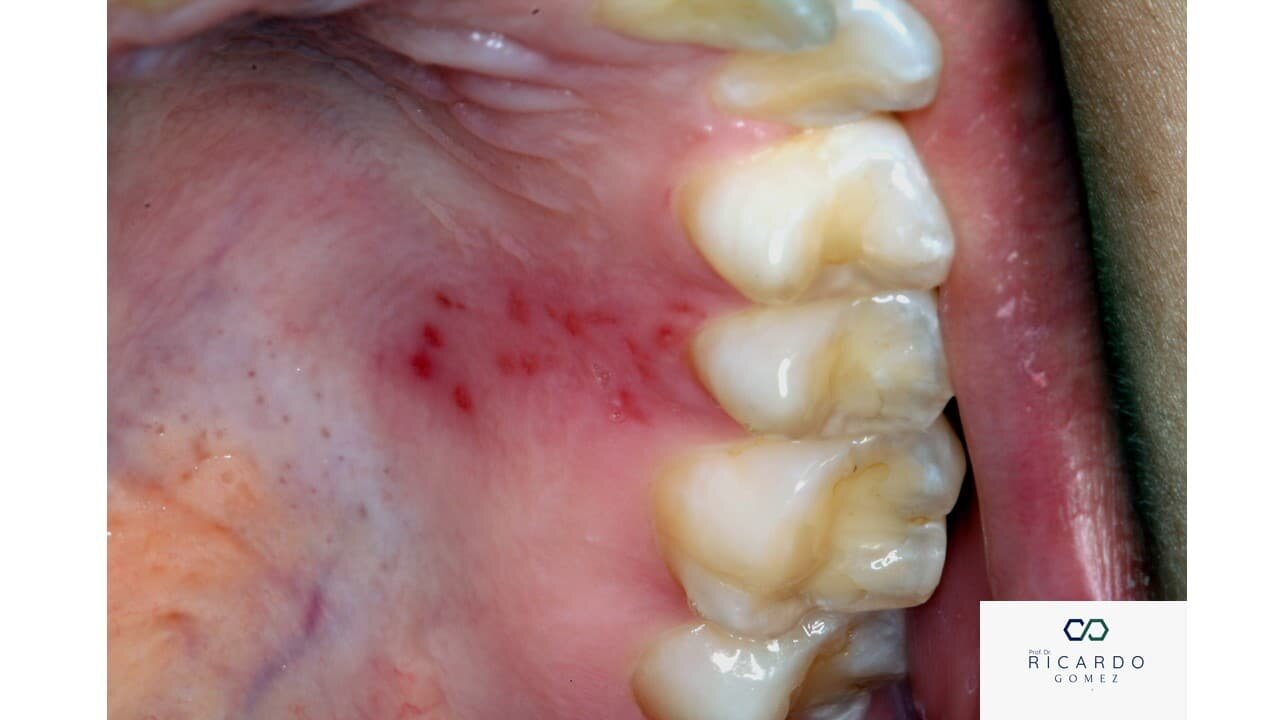 Herpes Simples - Patologia Bucal