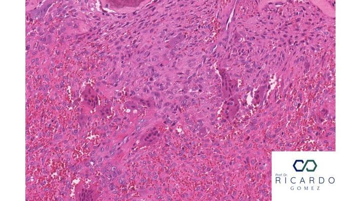 Granuloma Central de Células Gigantes - Patologia Bucal