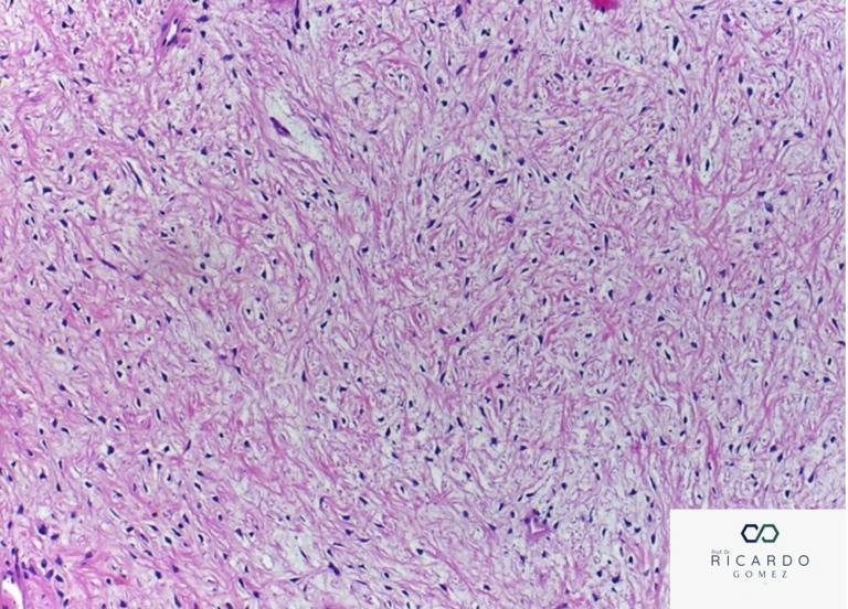 Mixoma Odontogênico - Patologia Bucal
