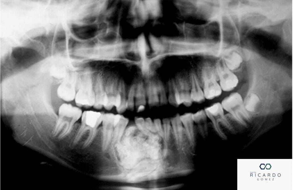 Odontoma - Patologia Bucal