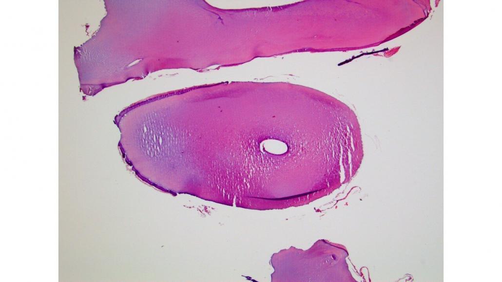 Odontoma - Patologia Bucal