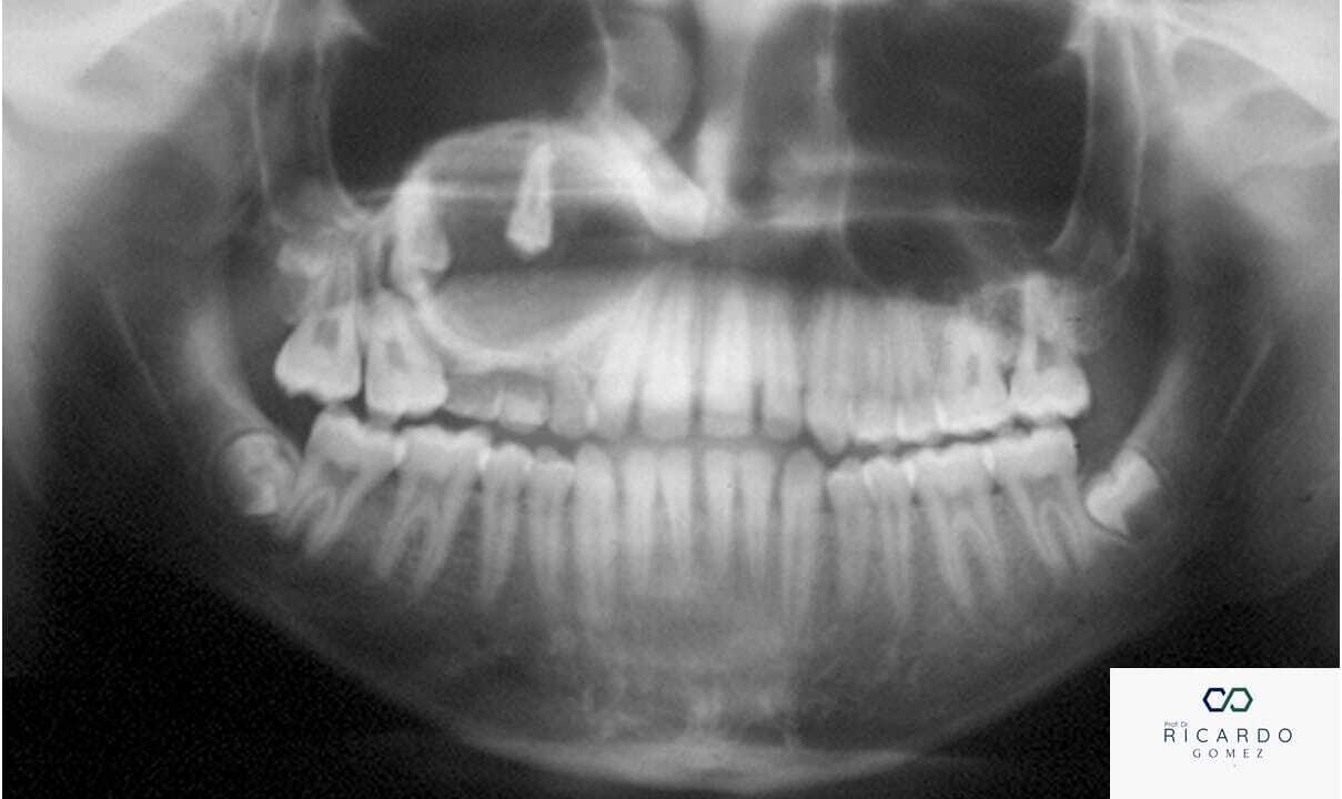 Radiografia De Tumor Odontogenico Adenomatoide Tumor Odontogénico
