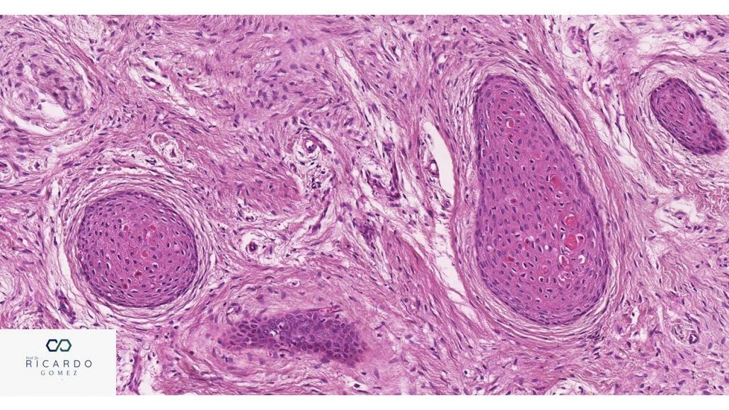 Histologia Do Mixoma Odontogenico