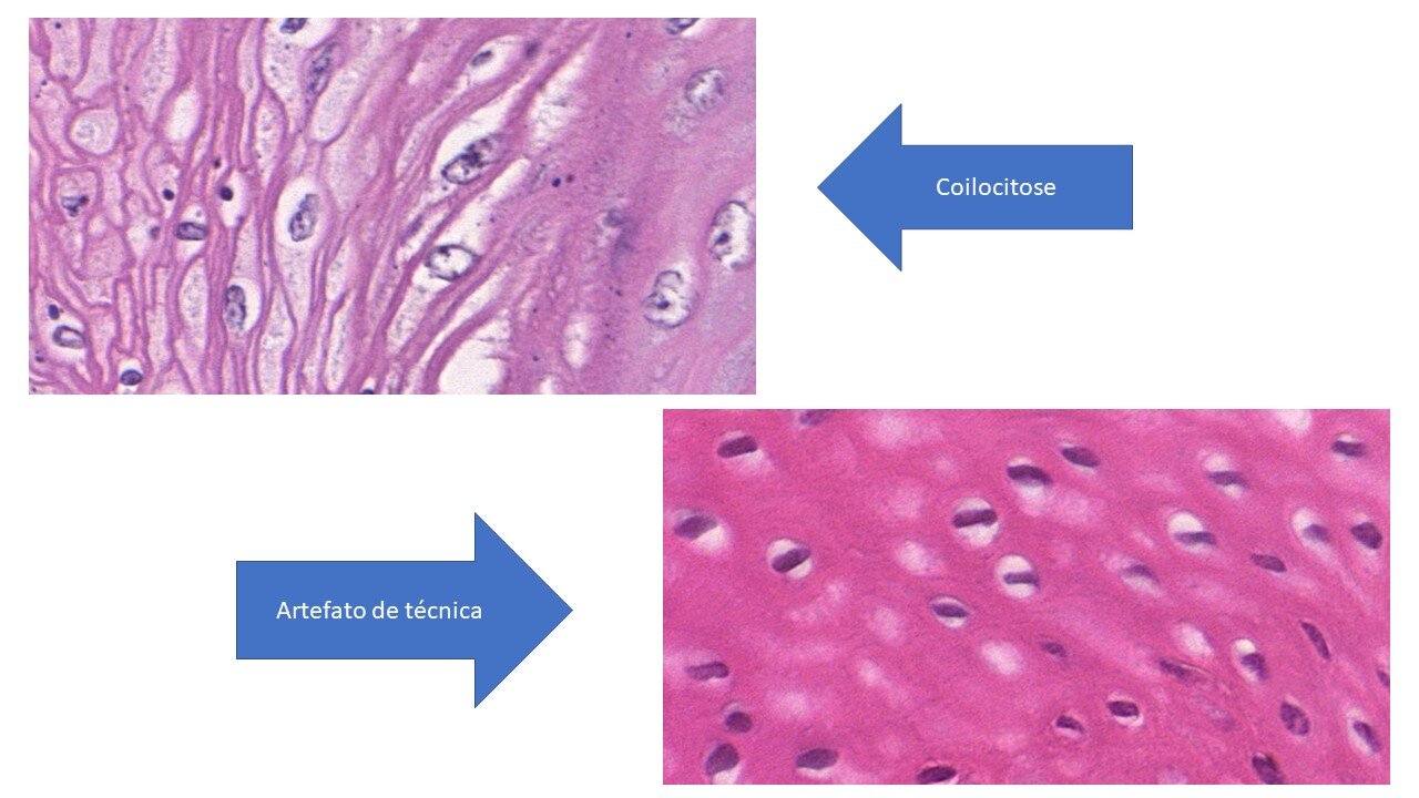 Histologia Da Verruga Plana Verruca Plantaris Histology