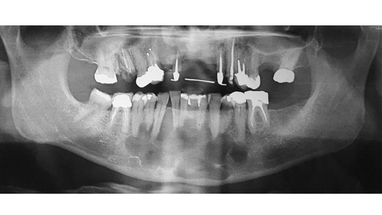 Cisto Odontogênico Glandular - Patologia Bucal
