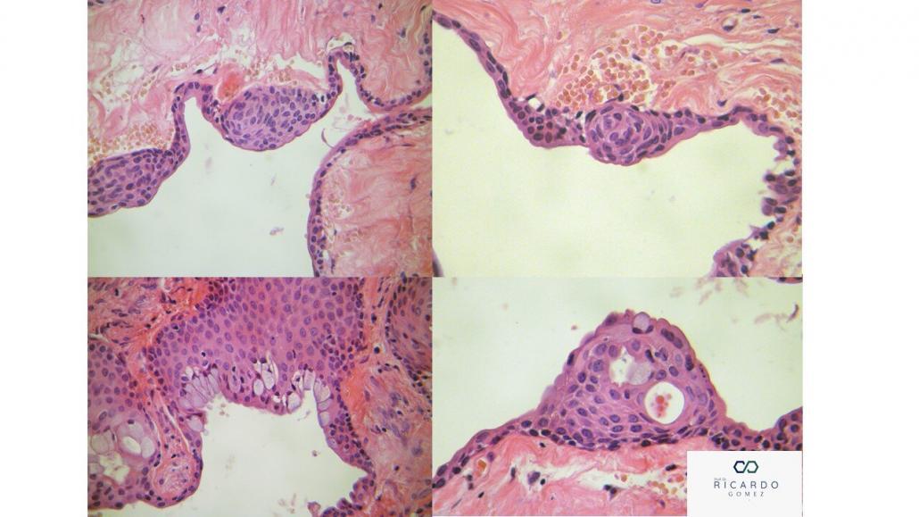 Histologia Do Cisto Periodontal Lateral