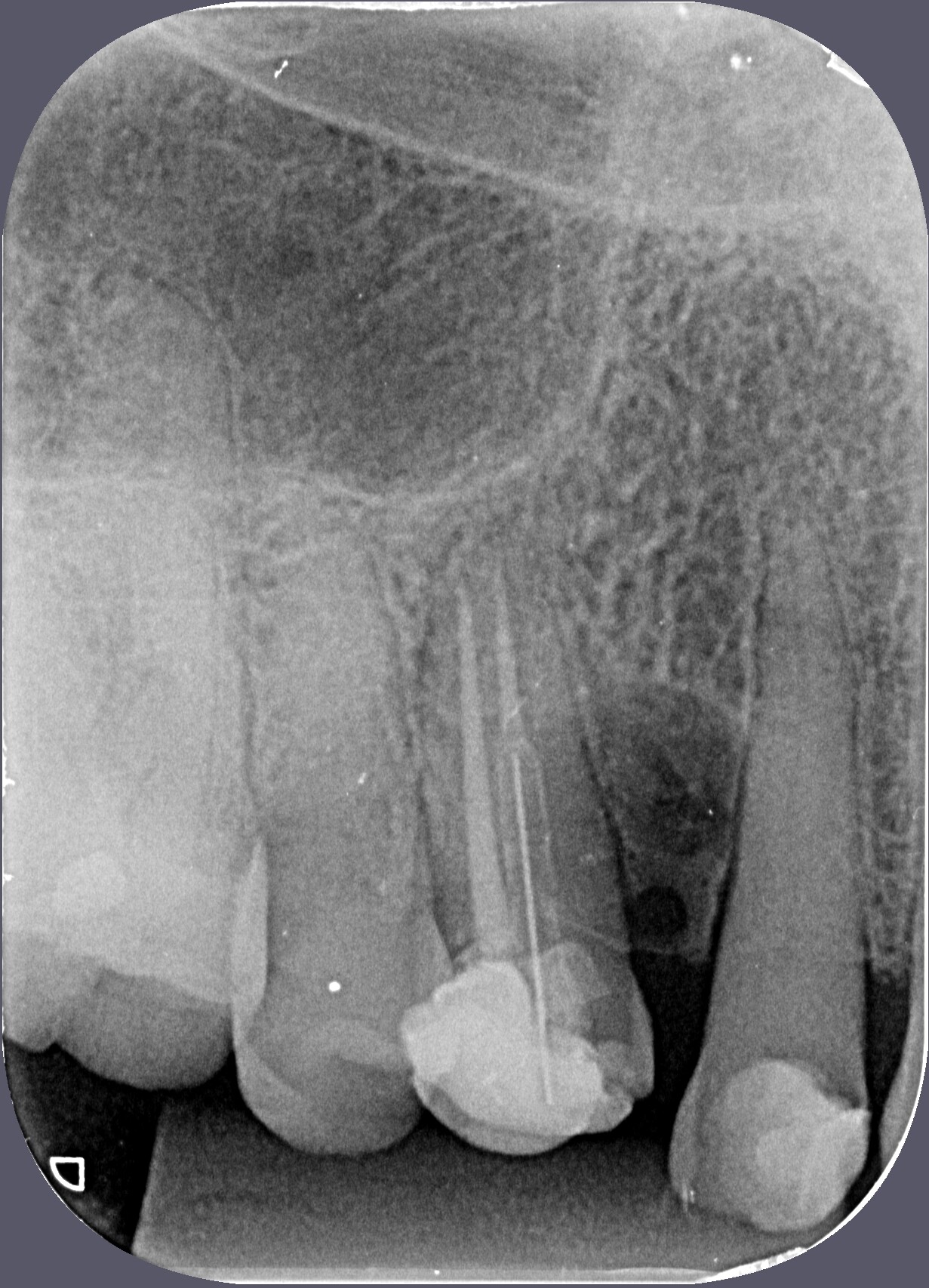 Cisto Periodontal Lateral - Patologia Bucal