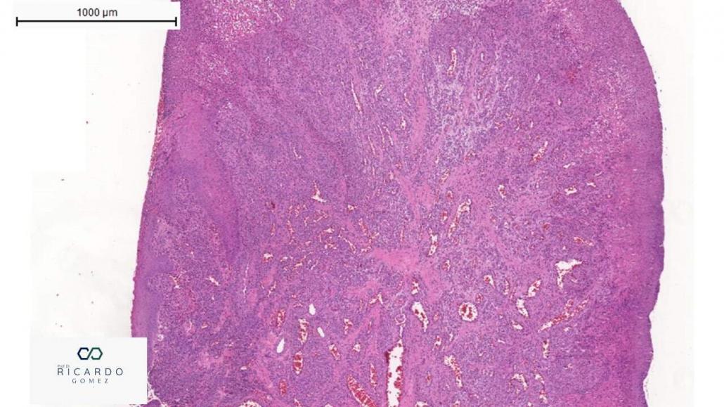 Granuloma Piogenico Oral Pyogenic Granuloma Wikipedia
