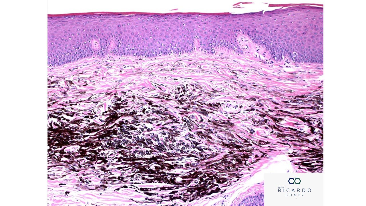 Nevus melanocítico - Patologia Bucal