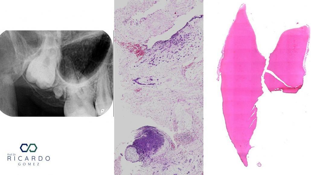 Histologia Do Odontoma Odontoma: Case Series & Report Of Cases