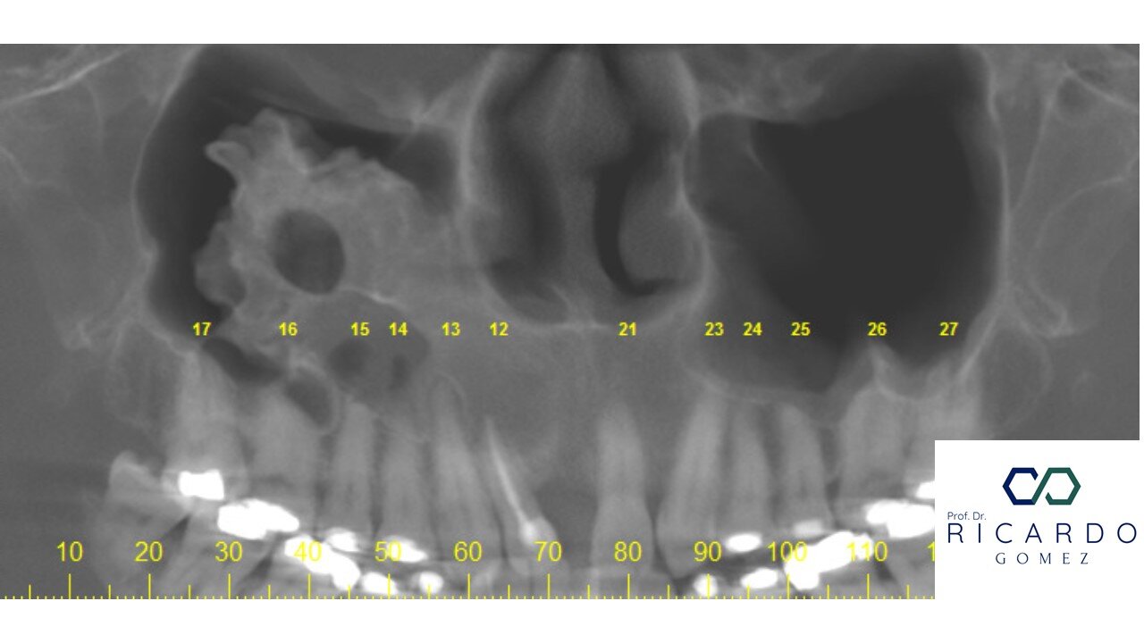 Osteogênese Reacional do Seio Maxilar - Patologia Bucal