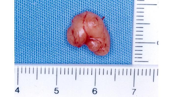 Osteoma - Patologia Bucal